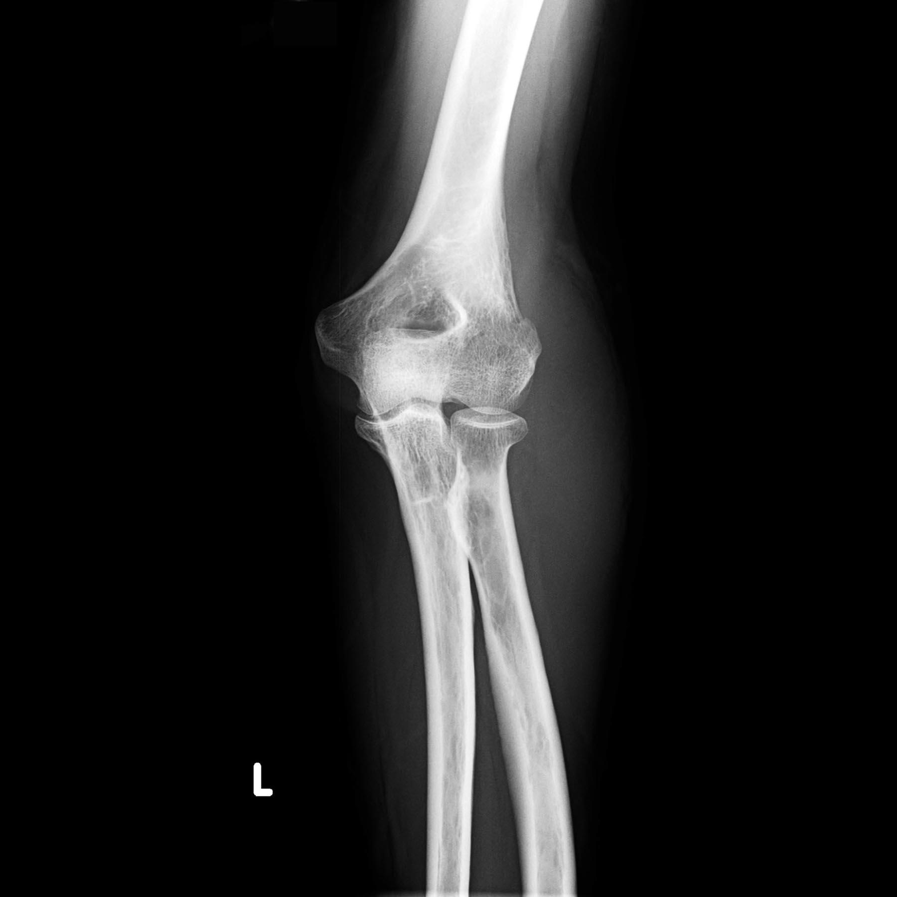Λ Bild 3/6 - Röntgen: Ellbogen ap Λ