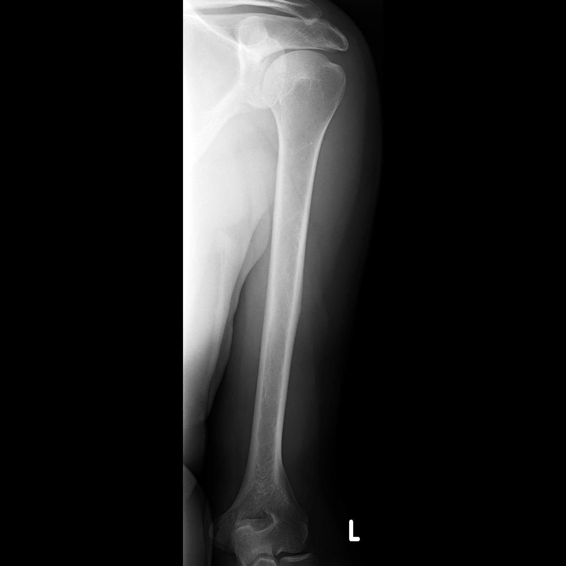 Λ Bild 1/6 - Röntgen: Oberarm ap Λ