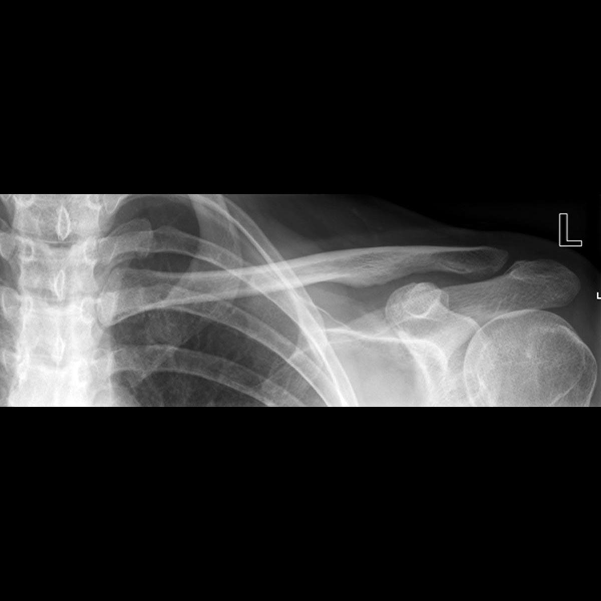 Λ Bild 3/4 - Röntgen: Clavicula ap Λ