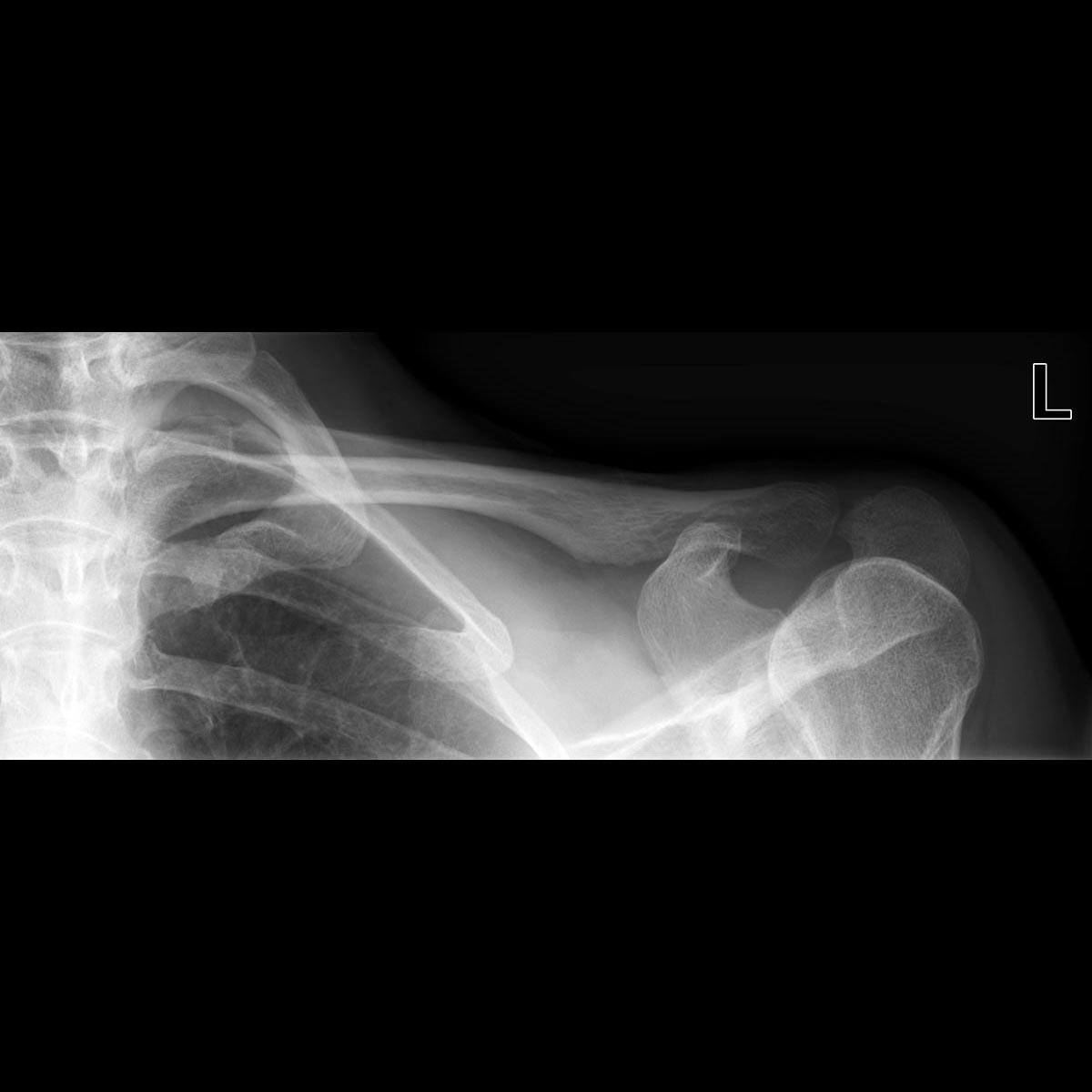 Bild 4/4 - Röntgen: Clavicula tangential