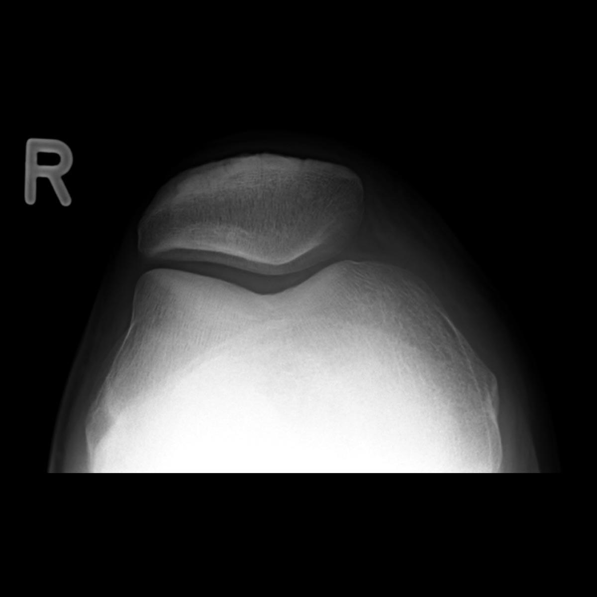 Λ Bild 7/9 - Röntgen: Patella axial Λ
