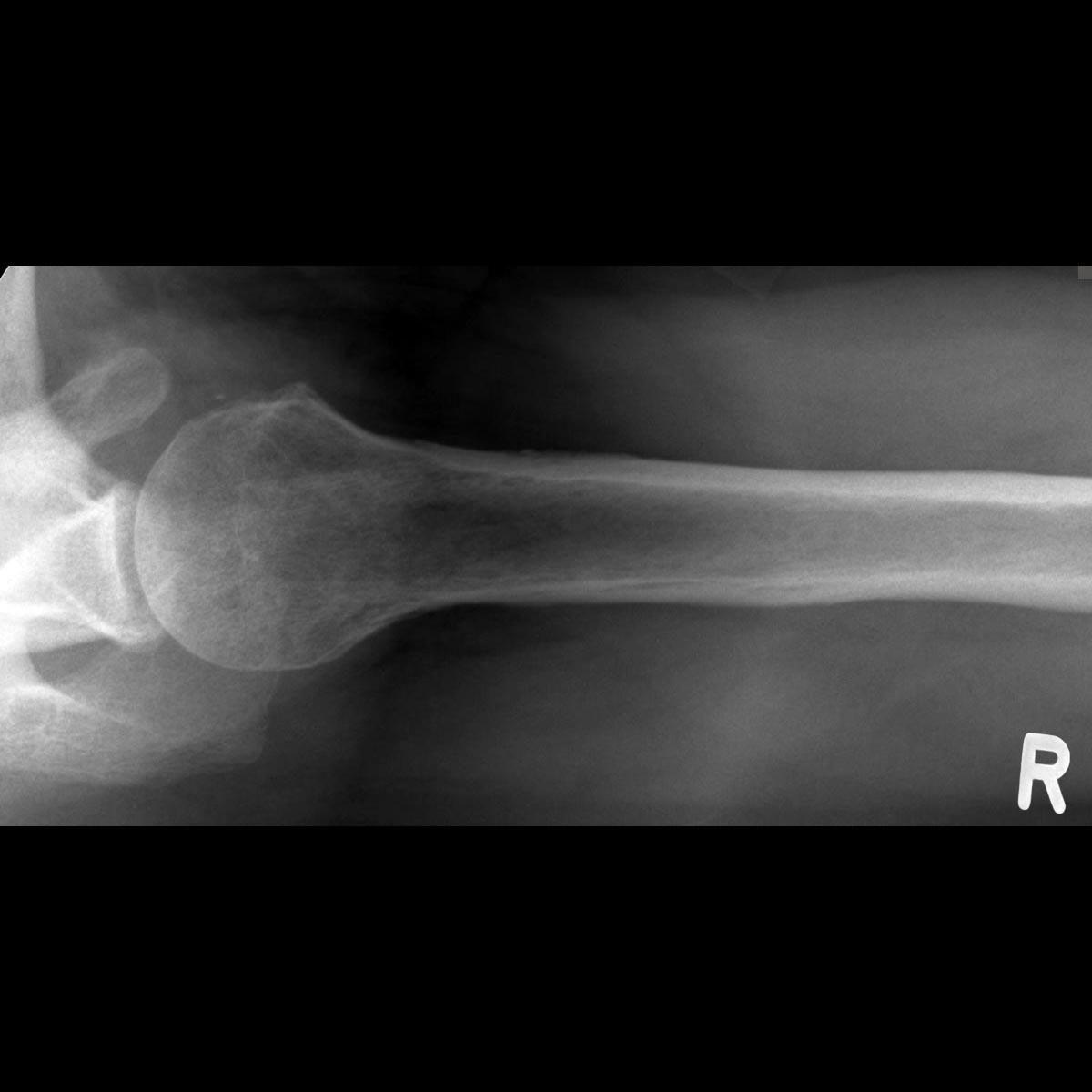 Λ Bild 2/8 - Röntgen: Schulter axial im Sitzen Λ