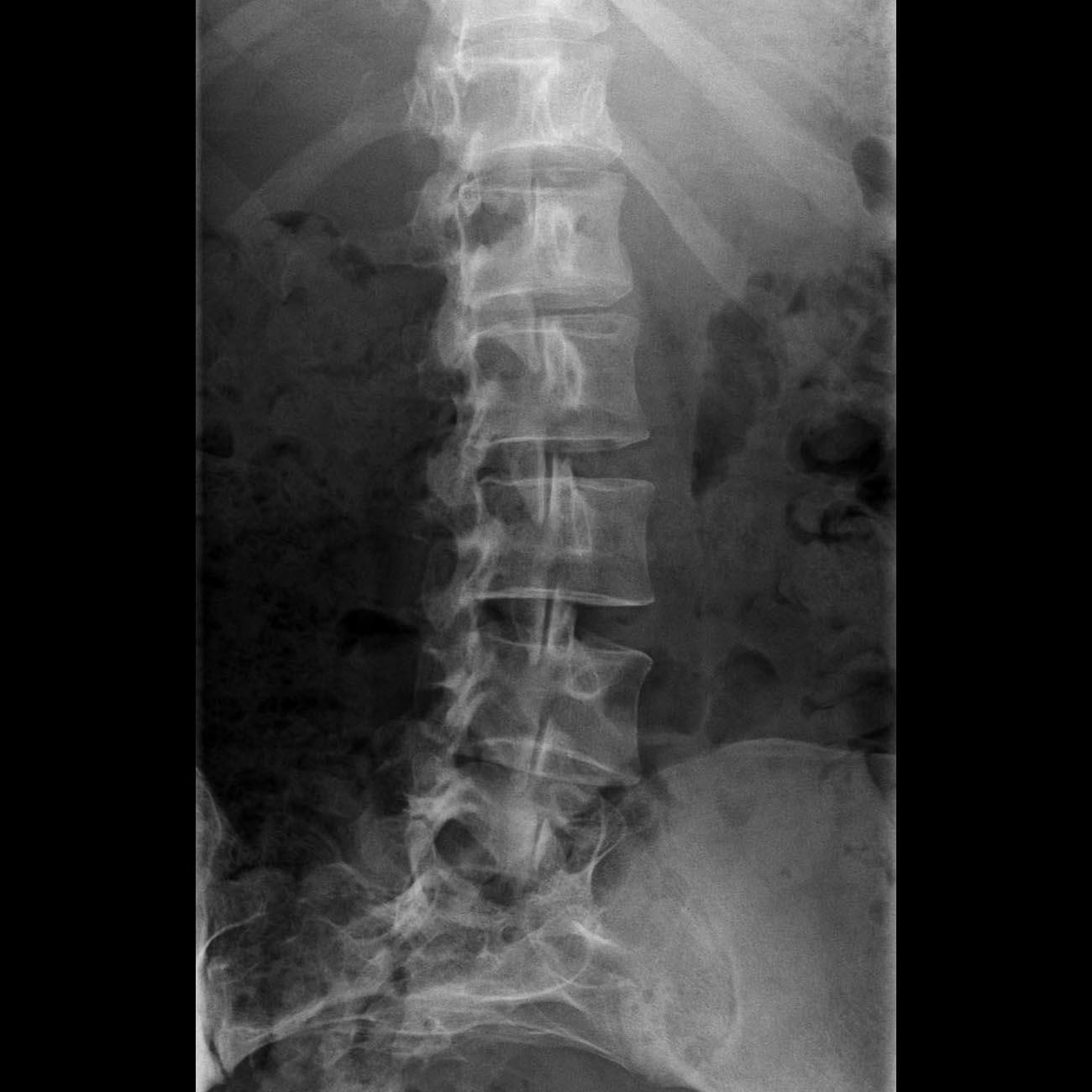 Bild 3/4 - Röntgen: LWS schräg