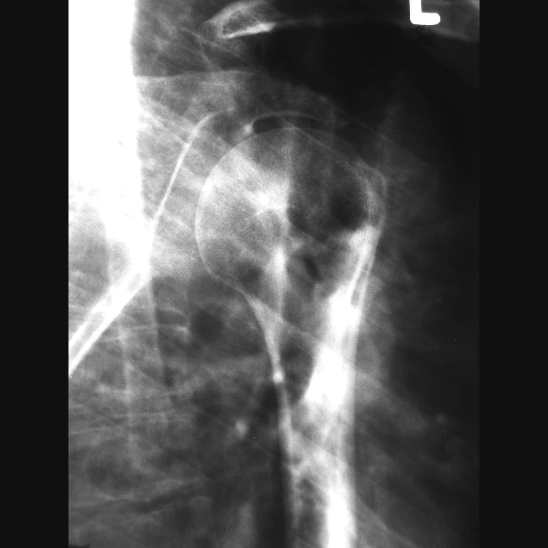 Λ Bild 4/8 - Röntgen: Schulter seitlich (transthorakal) Λ