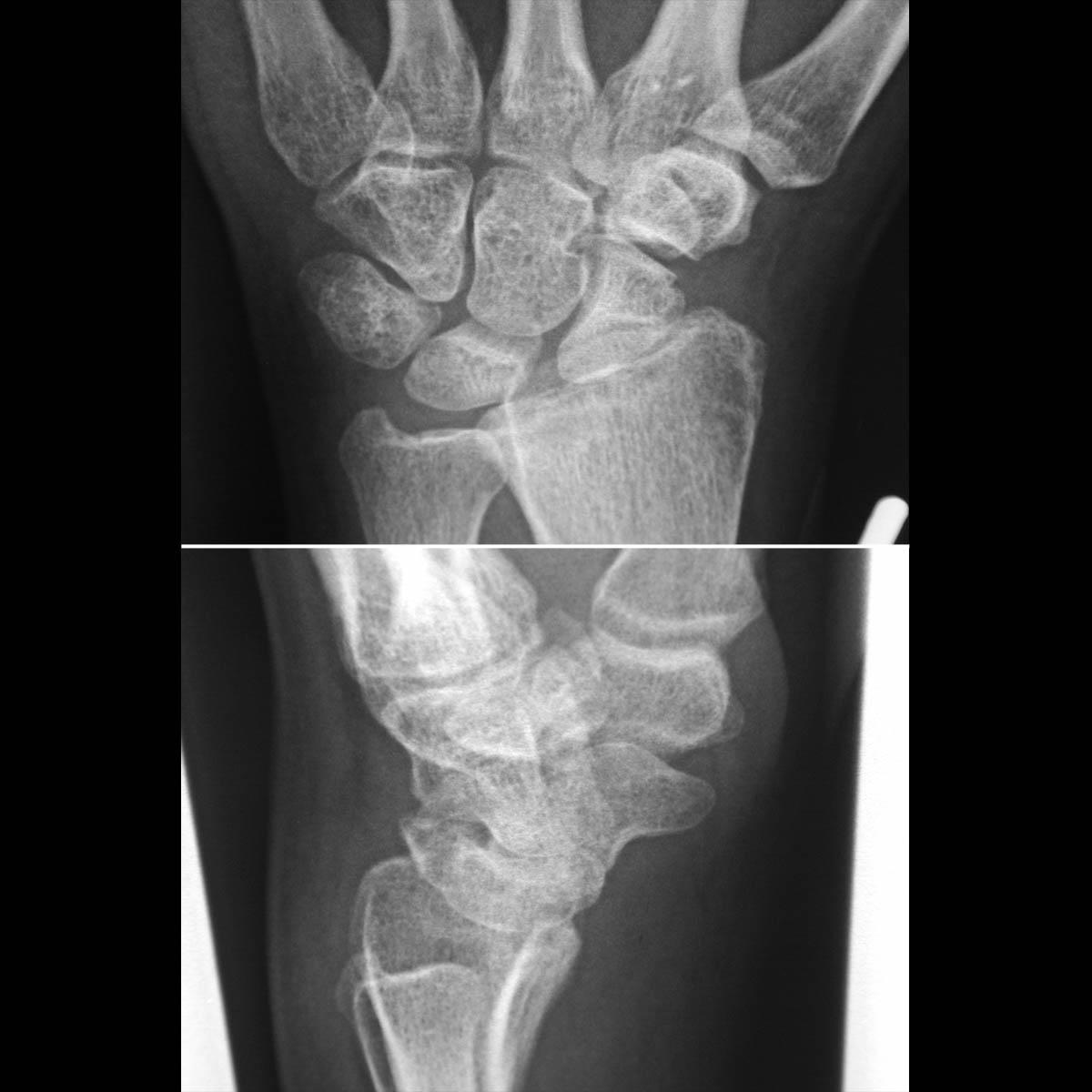 Bild 38/60 - Röntgen: Schmerzen im Handgelenk nach Handballspiel, 38-j ...