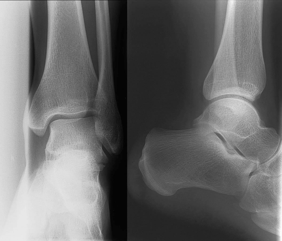 Bild 10/59 - Röntgen: Frontalkollision, 26-j. Frau