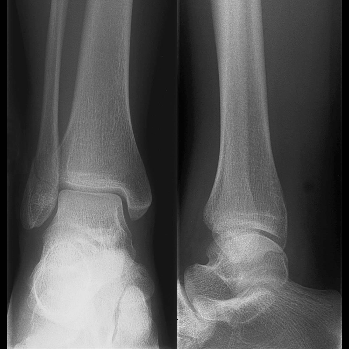 Λ Bild 8/59 - Röntgen: Misstritt beim Tanzen, 28-j. Frau Λ
