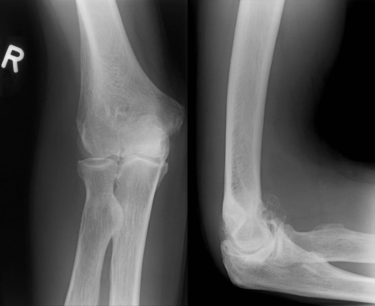 Bild 10/19 - Röntgen: Blockierungen im Ellbogen, 73-j. Mann