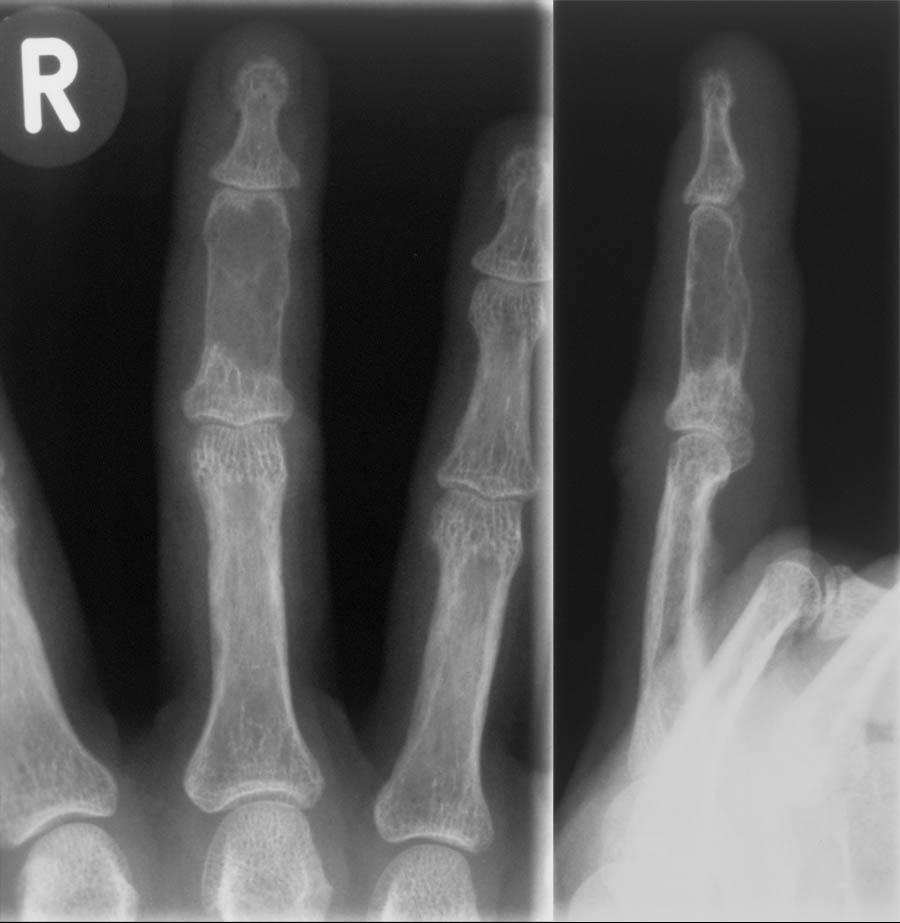 Λ Bild 14/37 - Röntgen: Schwellung am Mittelfinger, 29-j. Frau Λ
