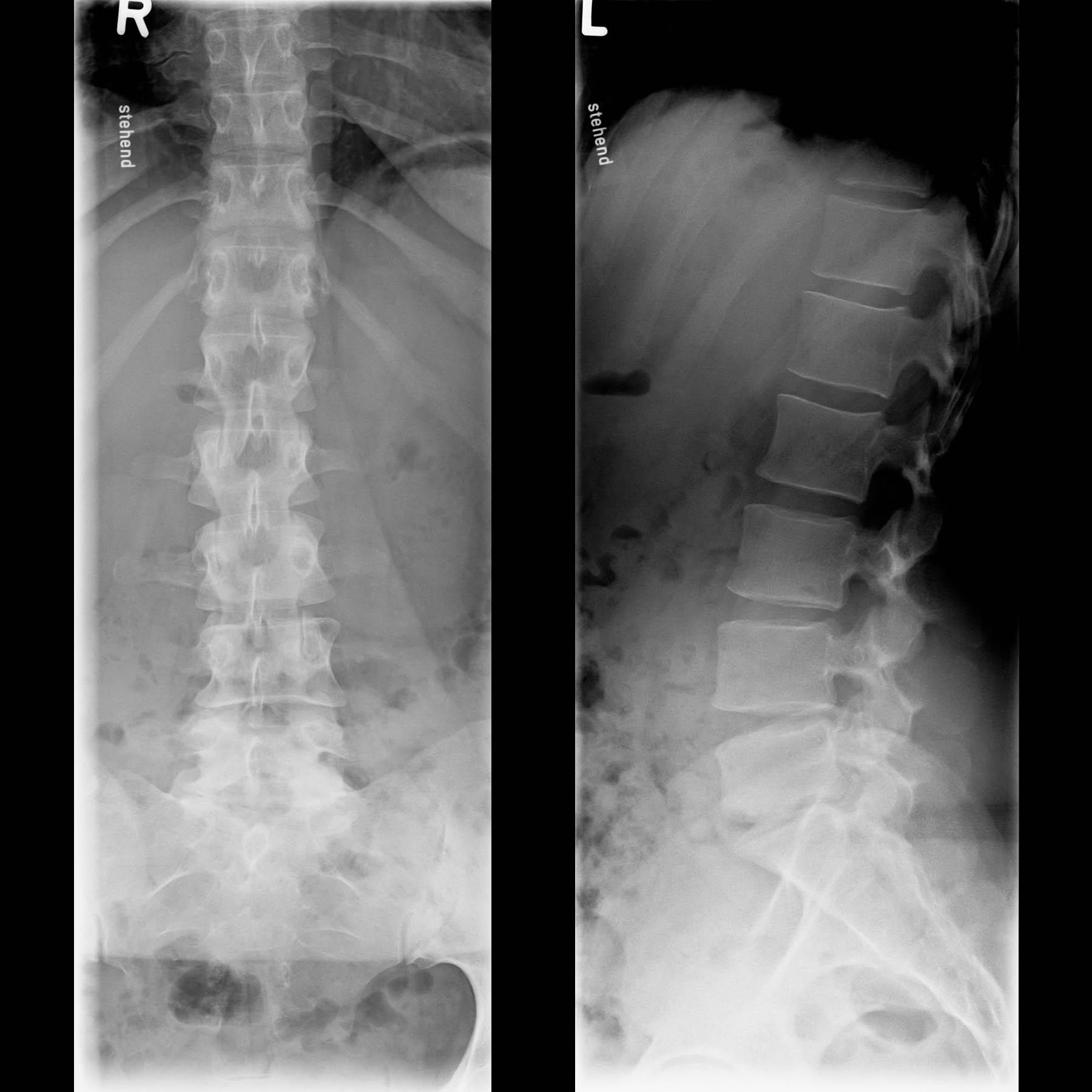 Bild 11/26 - Röntgen: Chron. Rückenschmerzen, 28-j. Frau