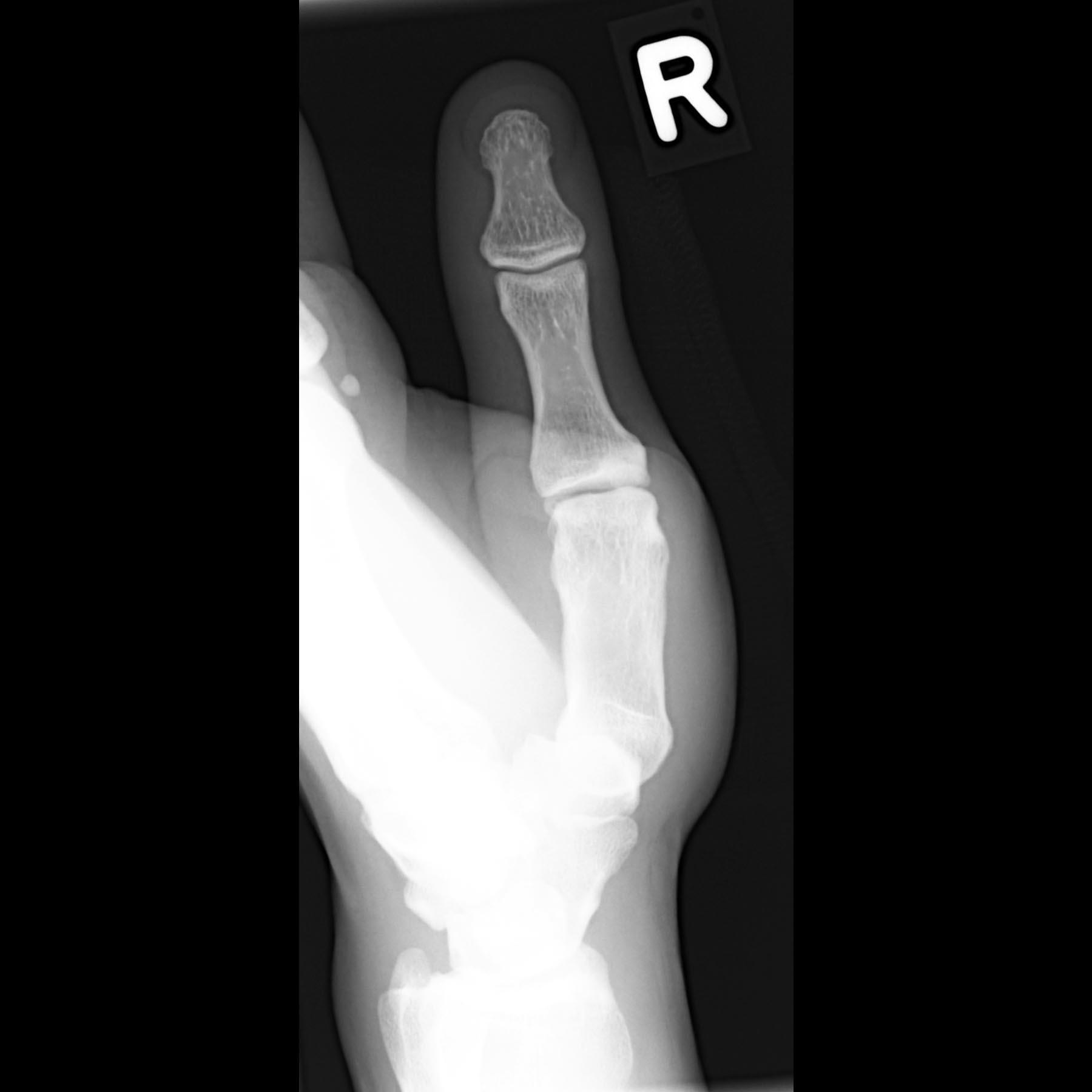 Bild 7/8 - Röntgen: Daumen vd