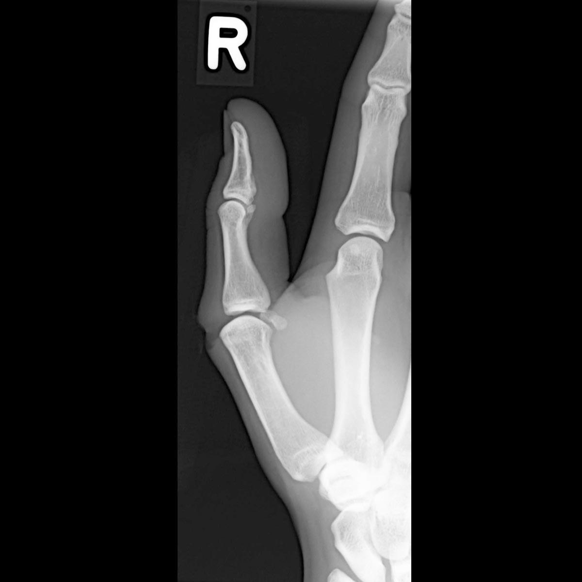 Bild 8/8 - Röntgen: Daumen seitlich ur