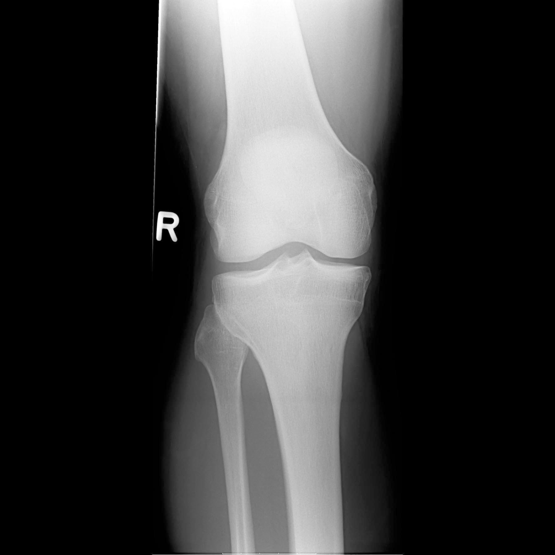 Bild 5/9 - Röntgen: Knie ap