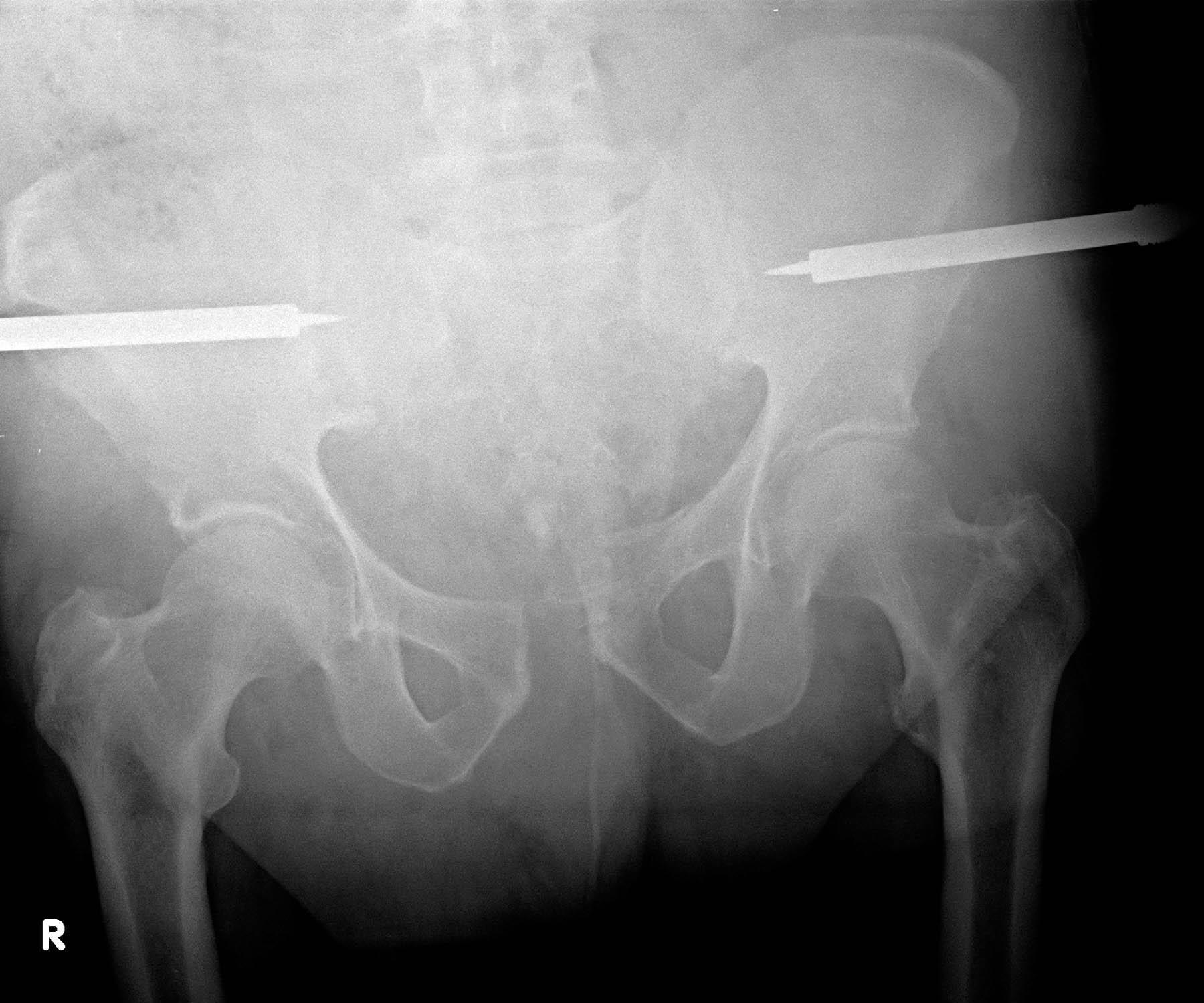 Bild 38/59 - Röntgen: Sturz von Leiter, 73-j. Mann