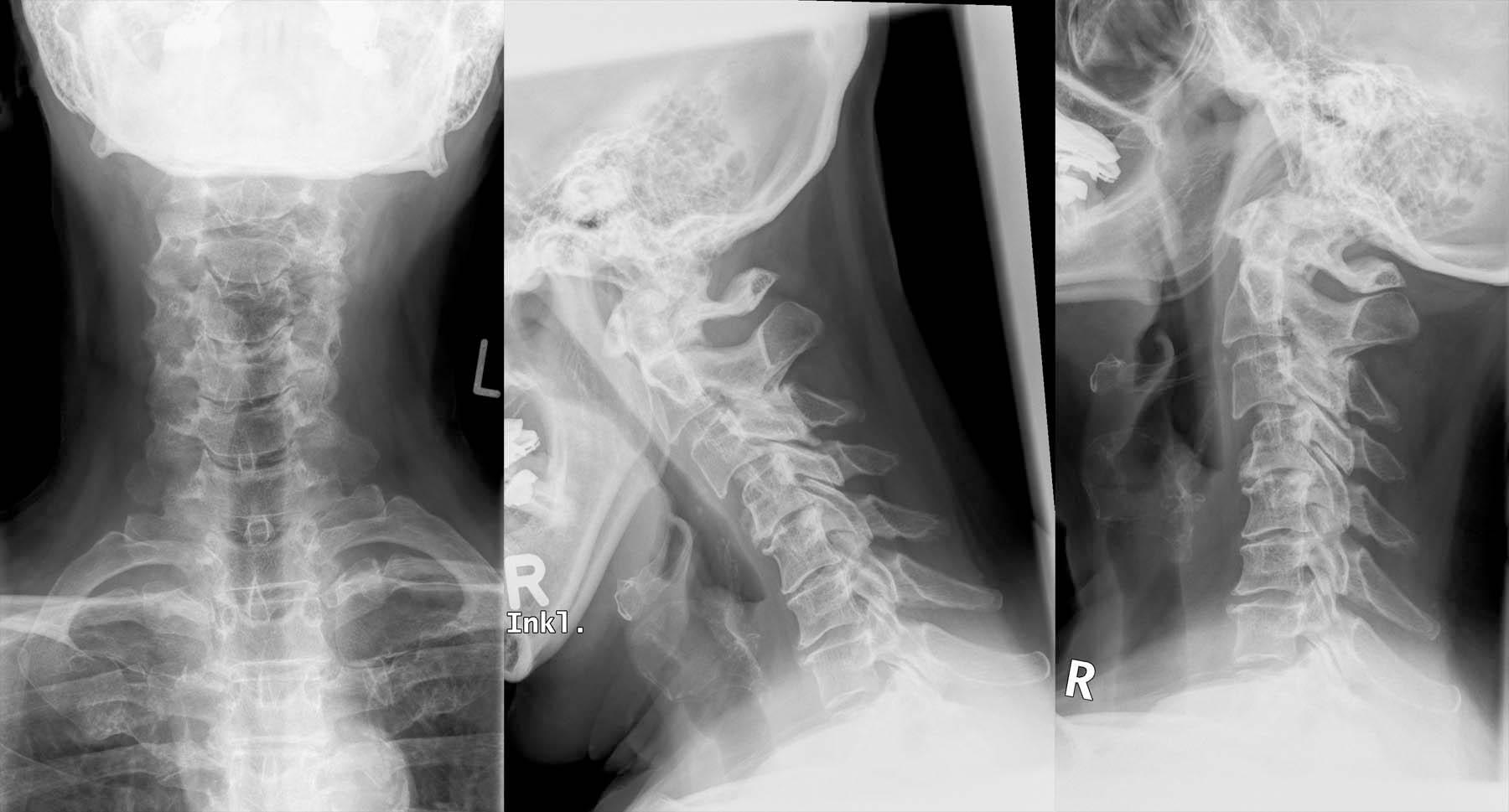 Bild 1/44 - Röntgen: Nackenschmerzen bei RA, 63-j. Frau