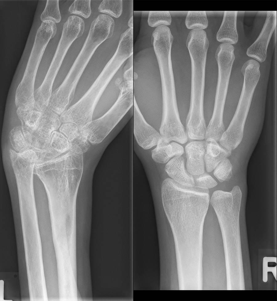Bild 6/43 - Röntgen: Alte Kriegsverletzung, 30-j. Mann