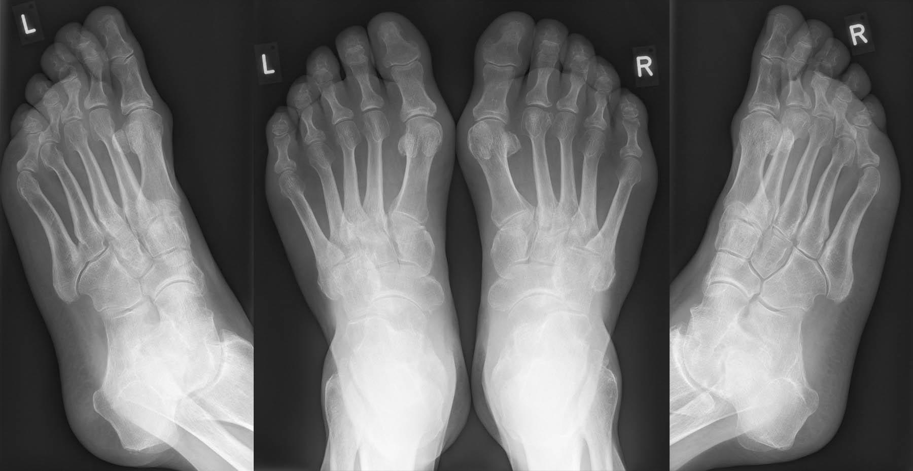 Bild 22/39 - Röntgen: Rheumatoide Arthritis, 62-j. Frau