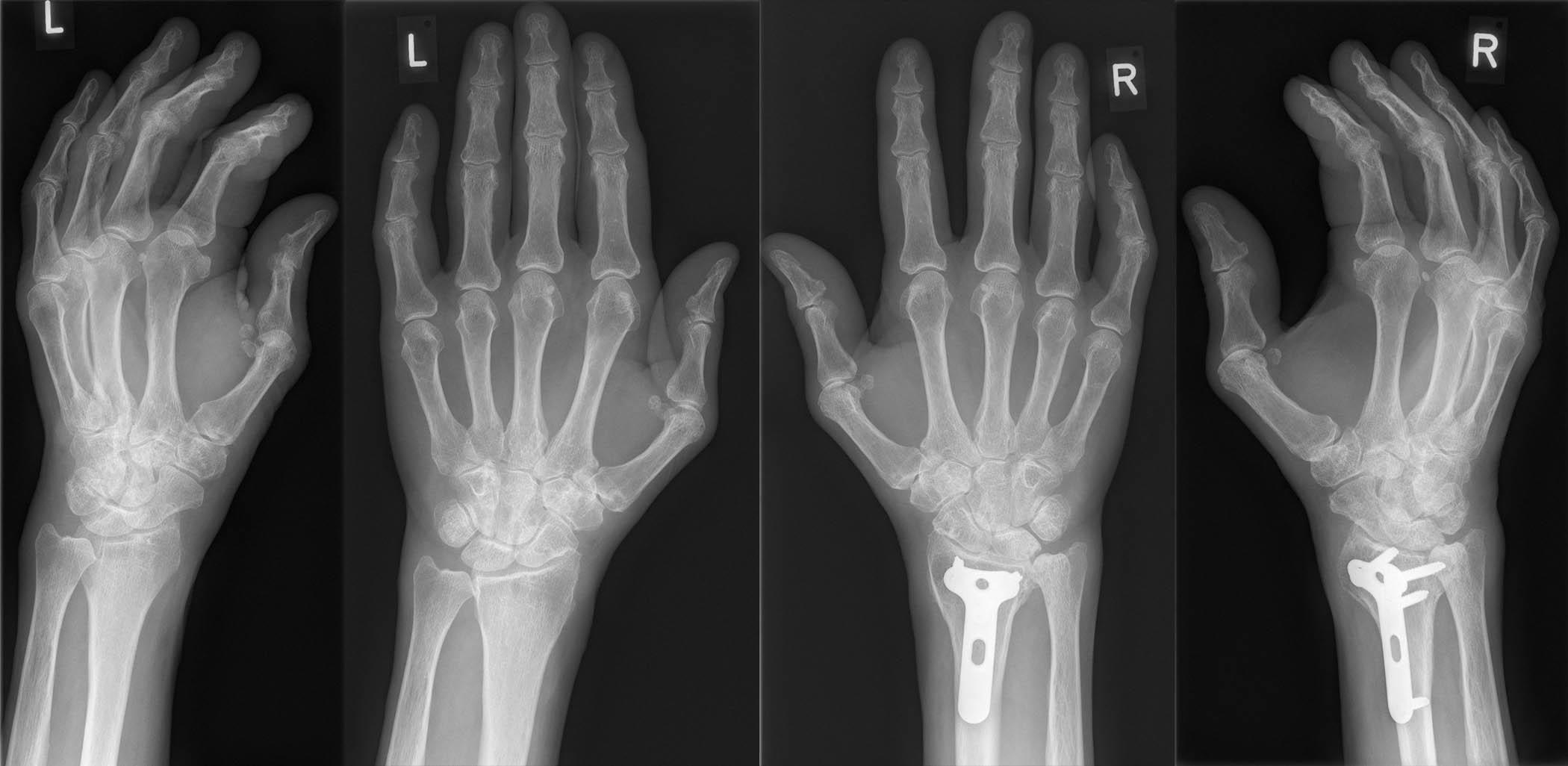 Bild 14/34 - Röntgen: Rheumatoide Arthritis62-j. Frau