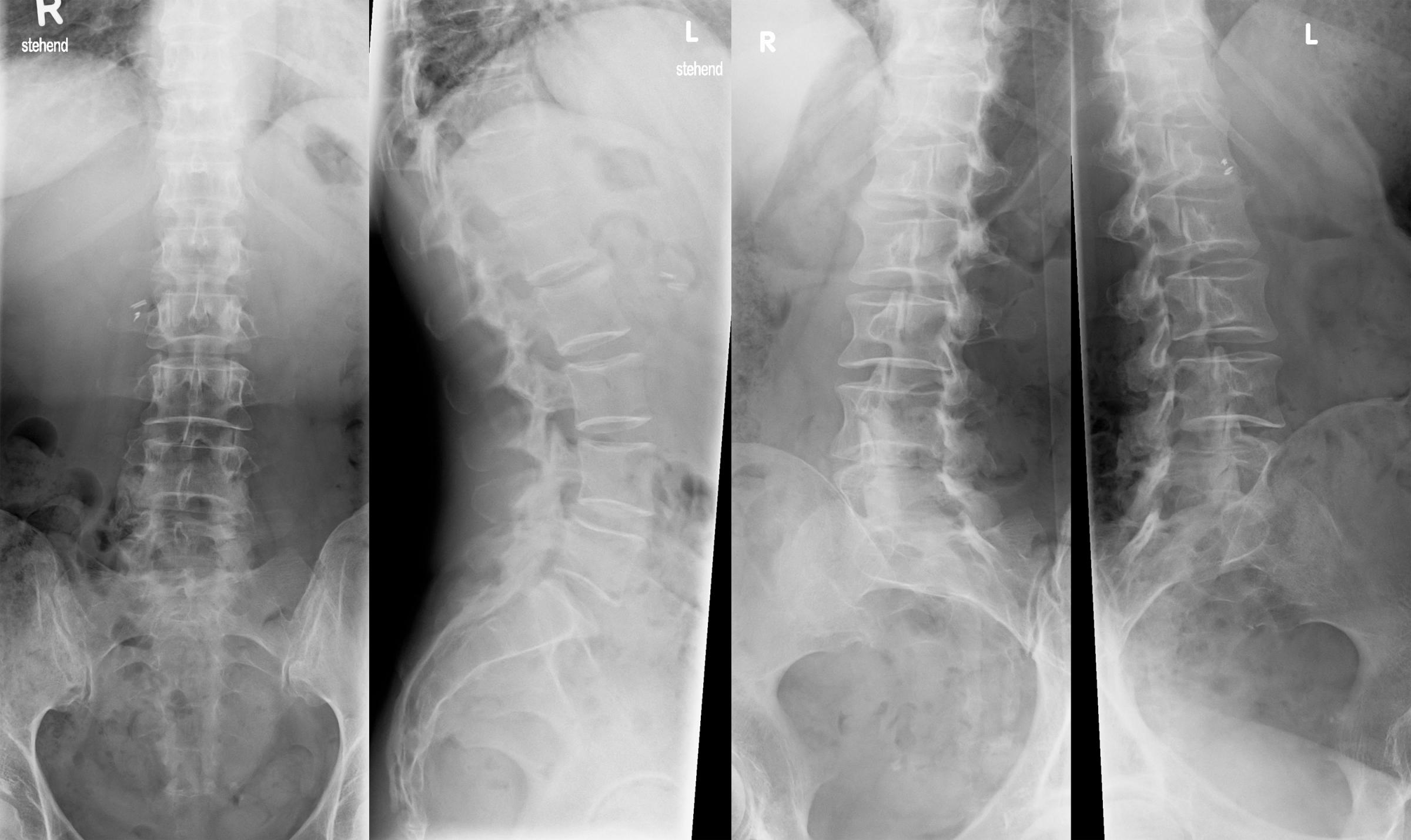 Bild 14/44 - Röntgen: Intermittierende Lumbago, 58-j. Frau