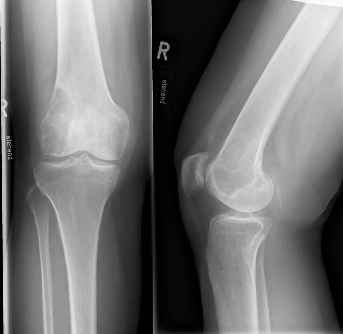 Λ Bild 25/37 - Röntgen: Knieschmerzen rechts, 46-j. Frau Λ