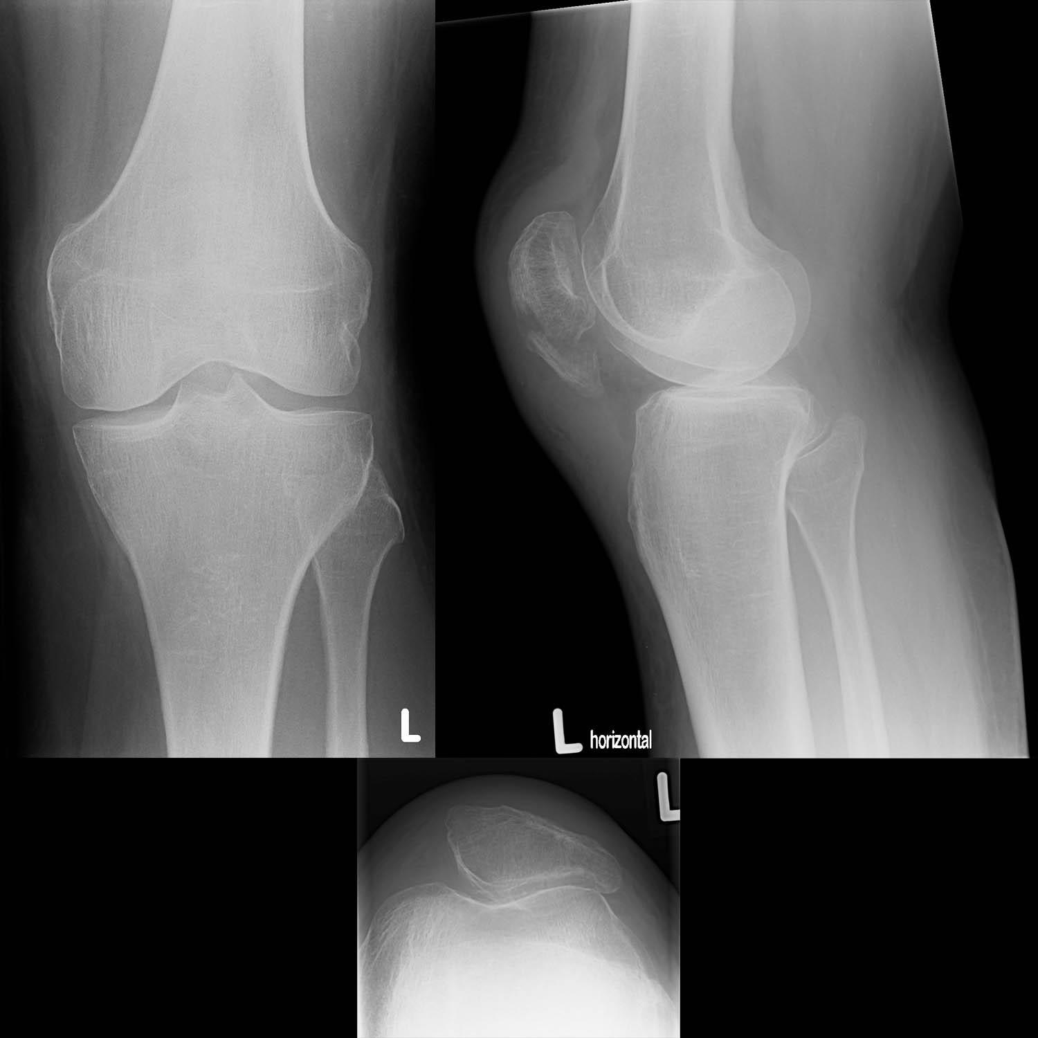 Λ Bild 15/59 - Röntgen: Sturz auf Knie li, 41-j. Mann Λ