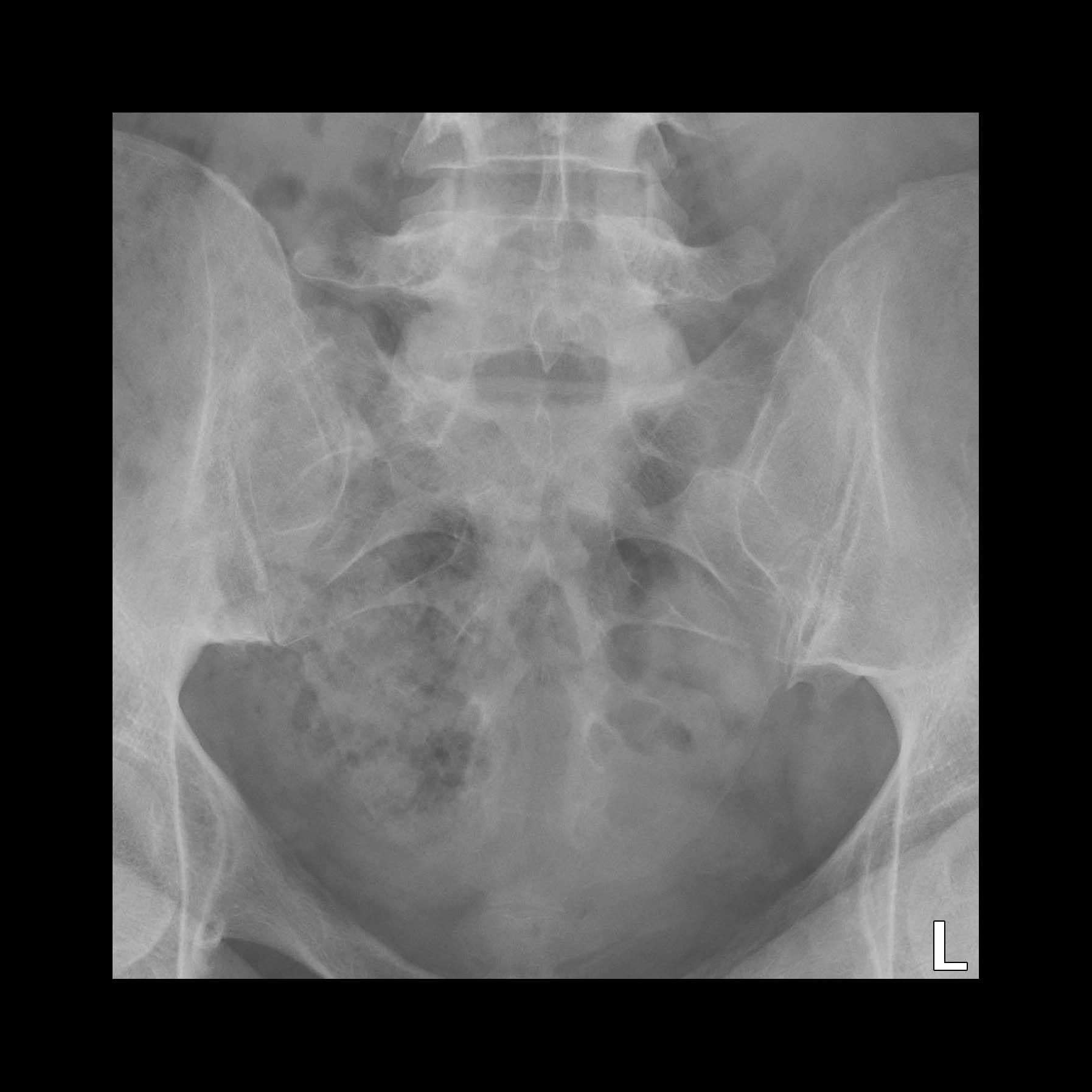 Λ Bild 3/7 - Röntgen: Sakrum ap Λ