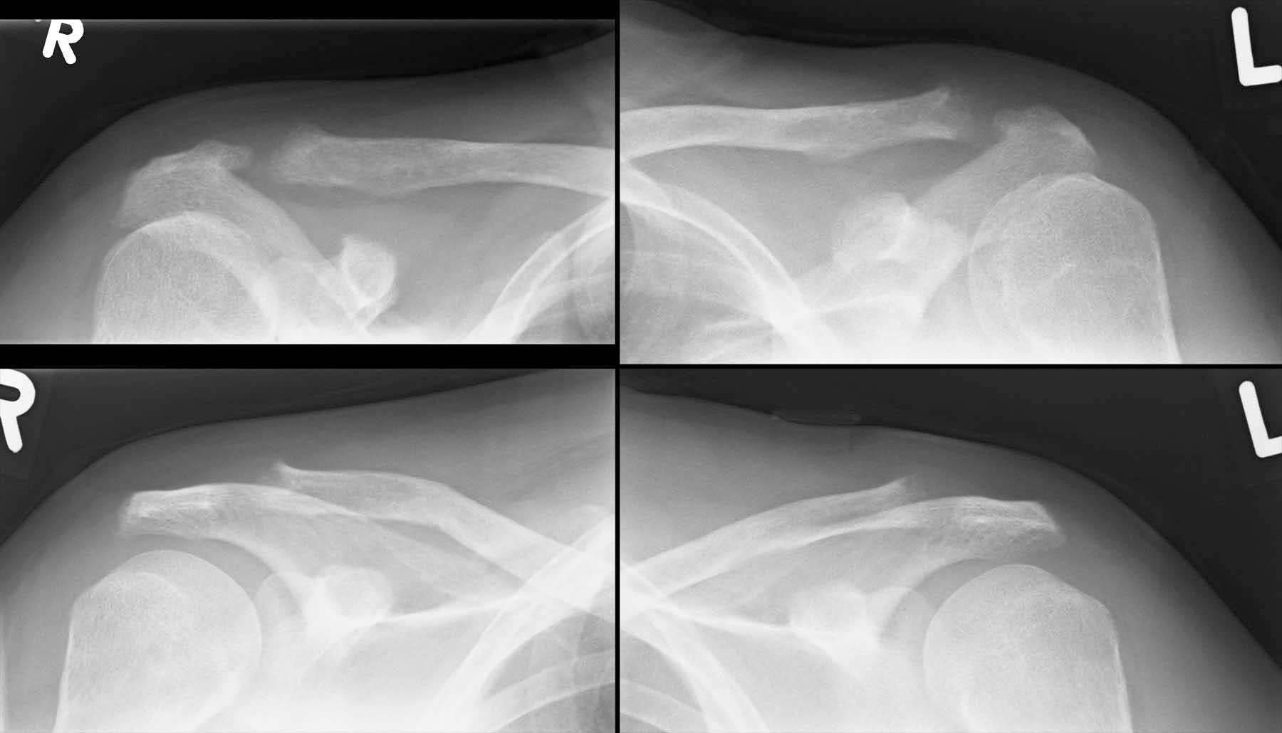 Bild 8/18 - Röntgen: Präterminale Niereninsuffizienz