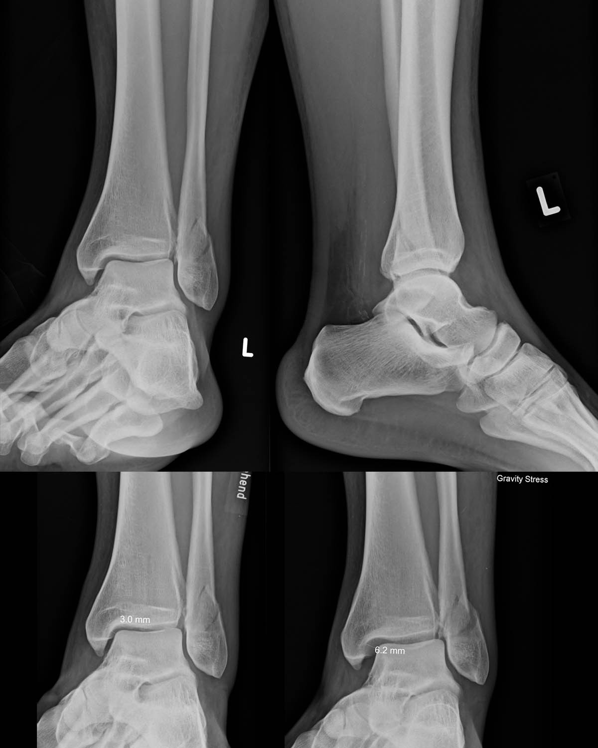 Bild 12/59 - Röntgen: Schiunfall, 45-j. Mann