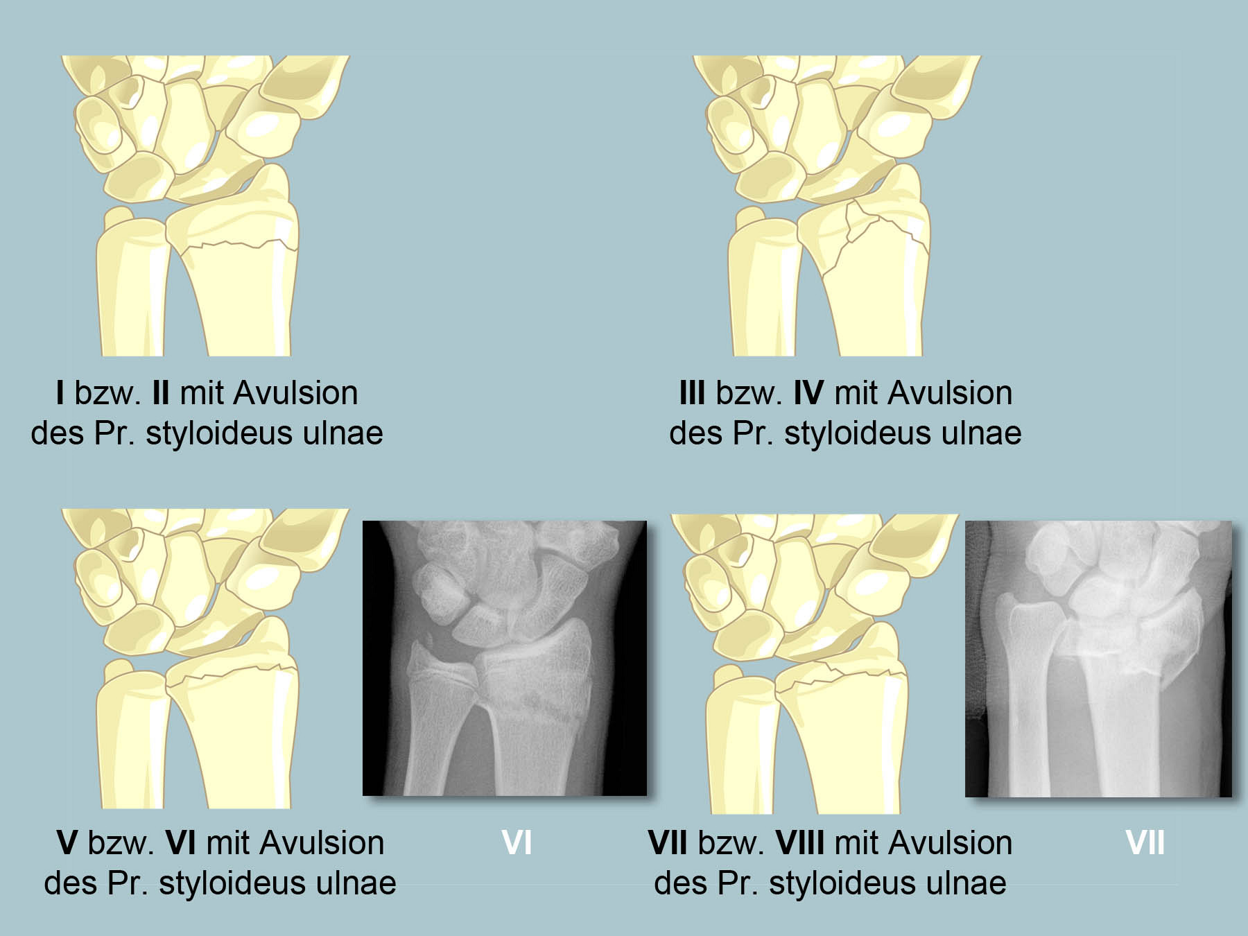 Bild 19/42 - Grafik: Distale Radiusfrakturen