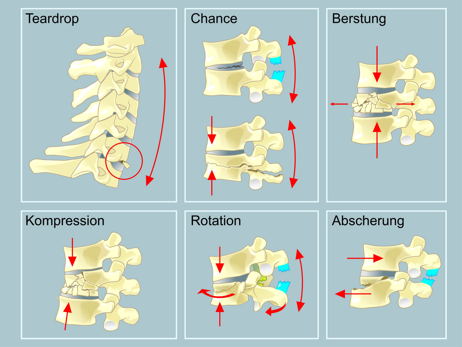 Λ Bild 22/42 - Grafik: Wirbelsäulenfrakturen Λ