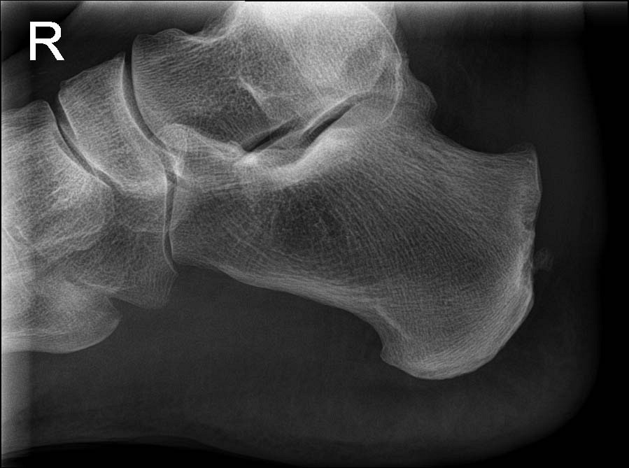 Λ Bild 14/39 - Röntgen: Schmerzen oberhalb Ferse, 66-j. Mann Λ