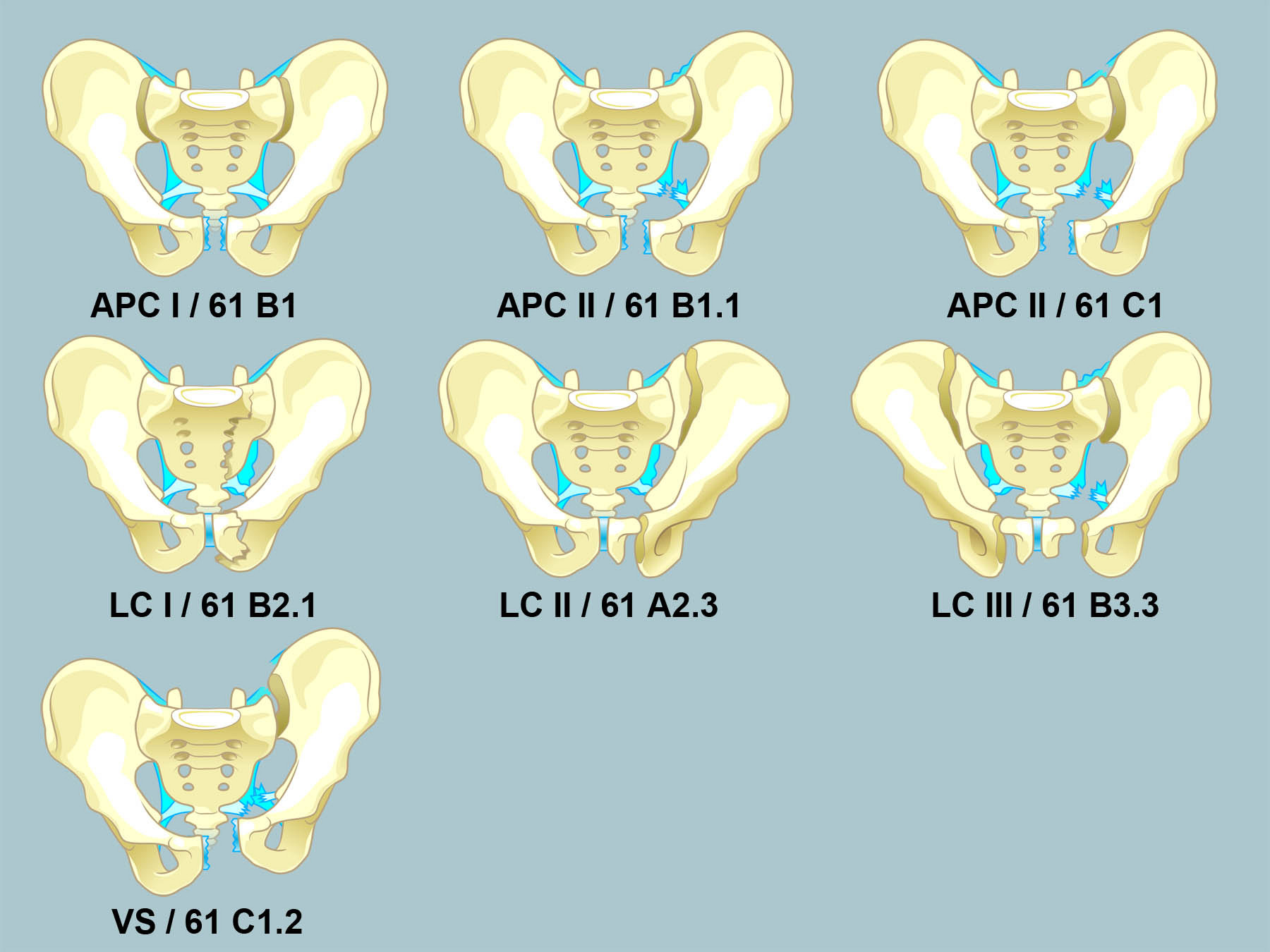 Λ Bild 26/42 - Grafik: Beckenringfrakturen Λ
