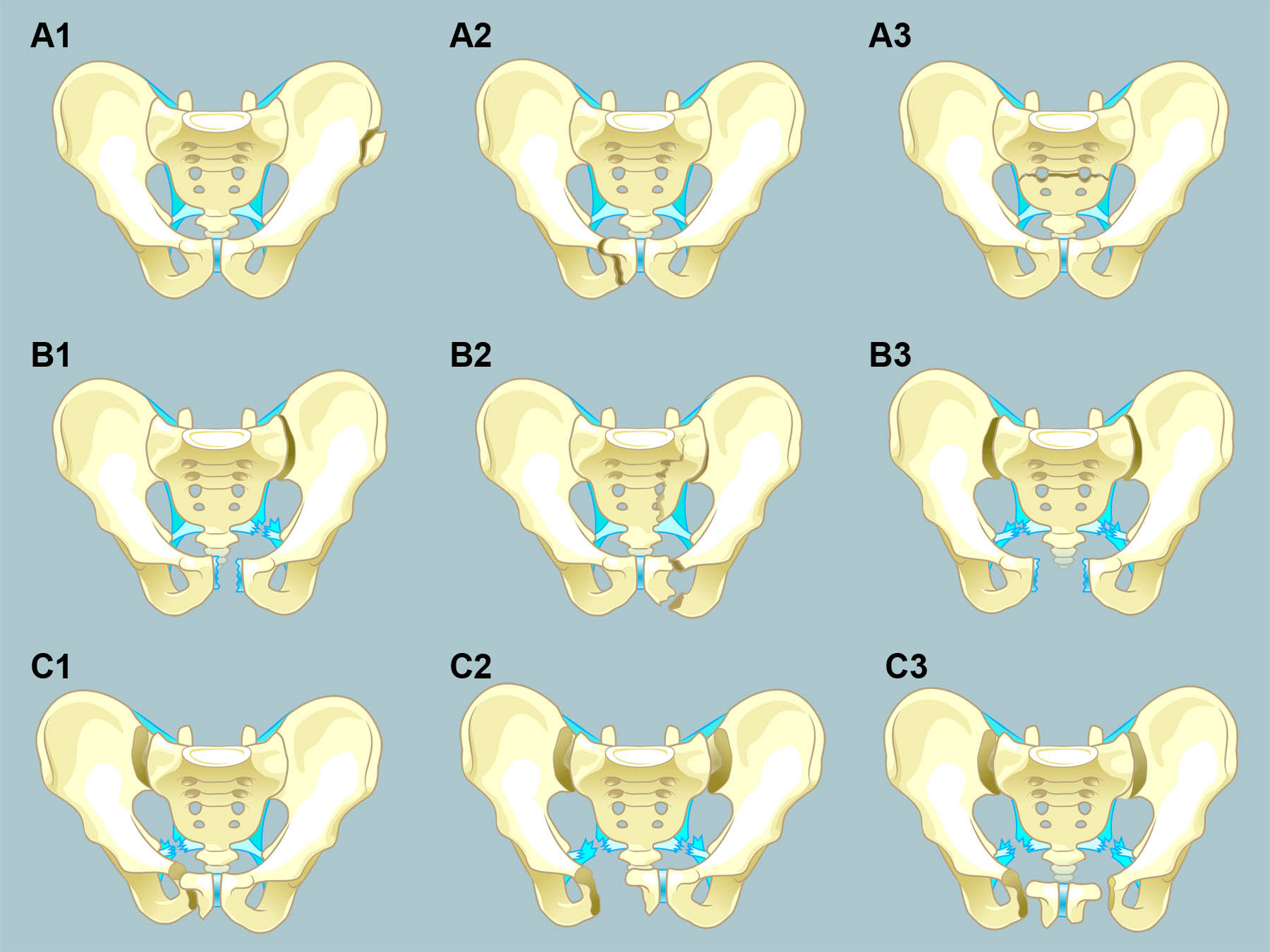 Bild 25/42 - Grafik: Beckenfrakturen