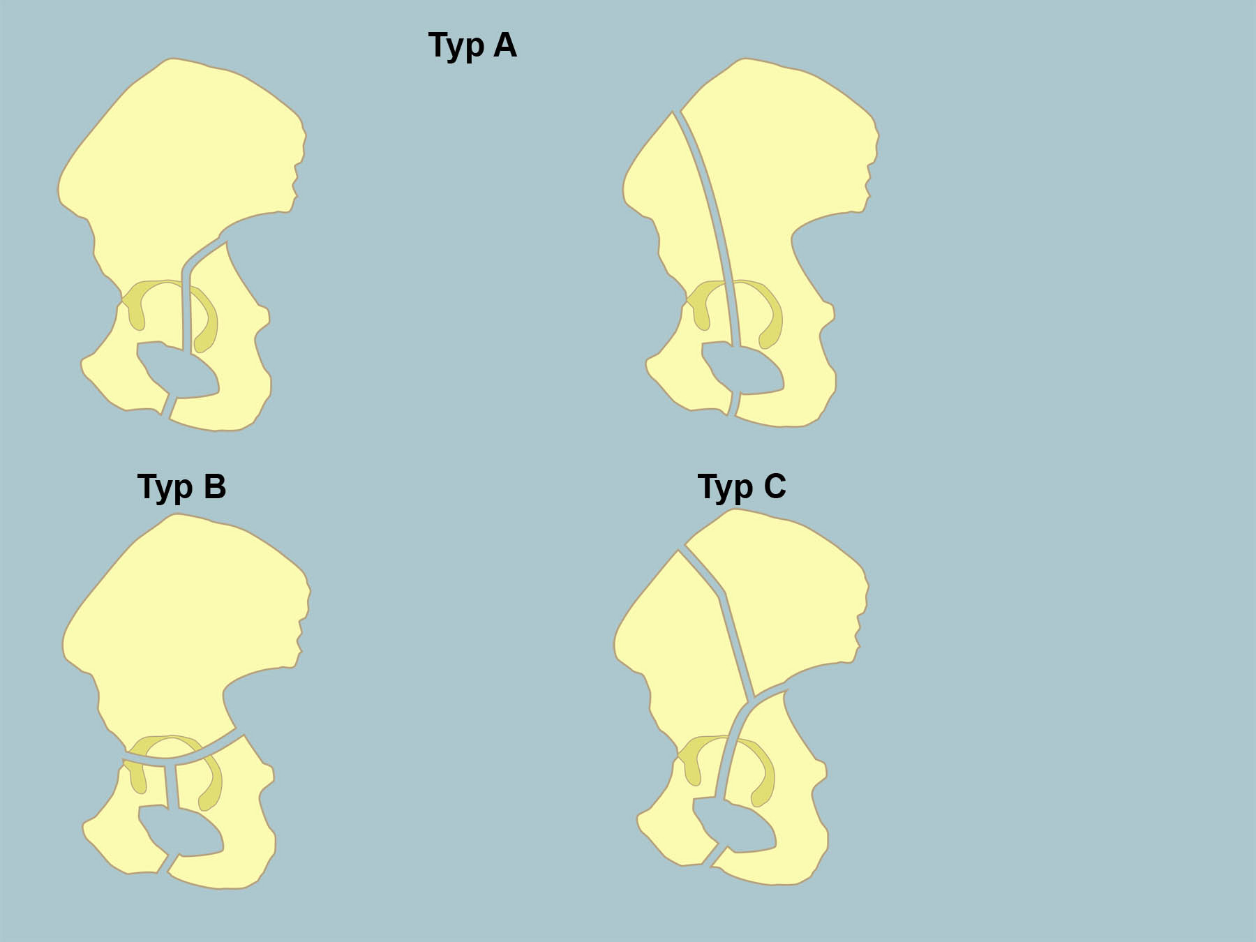 Λ Bild 27/42 - Grafik: Acetabulumfrakturen Λ