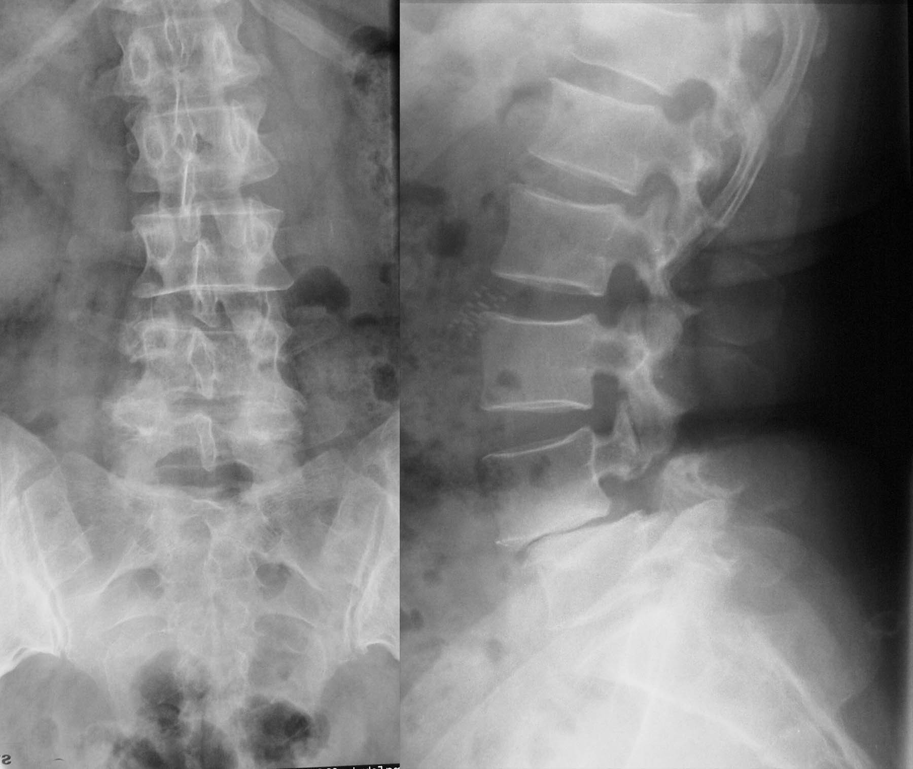 Bild 24/46 - Röntgen: Chronische Lumbalgie