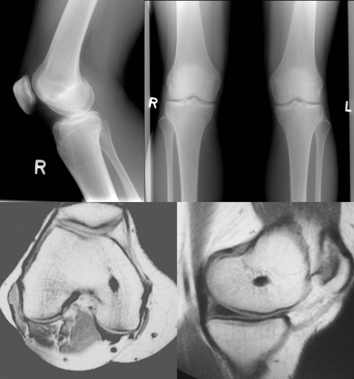 Bild 32/33 - Röntgen: Zufallsbefund