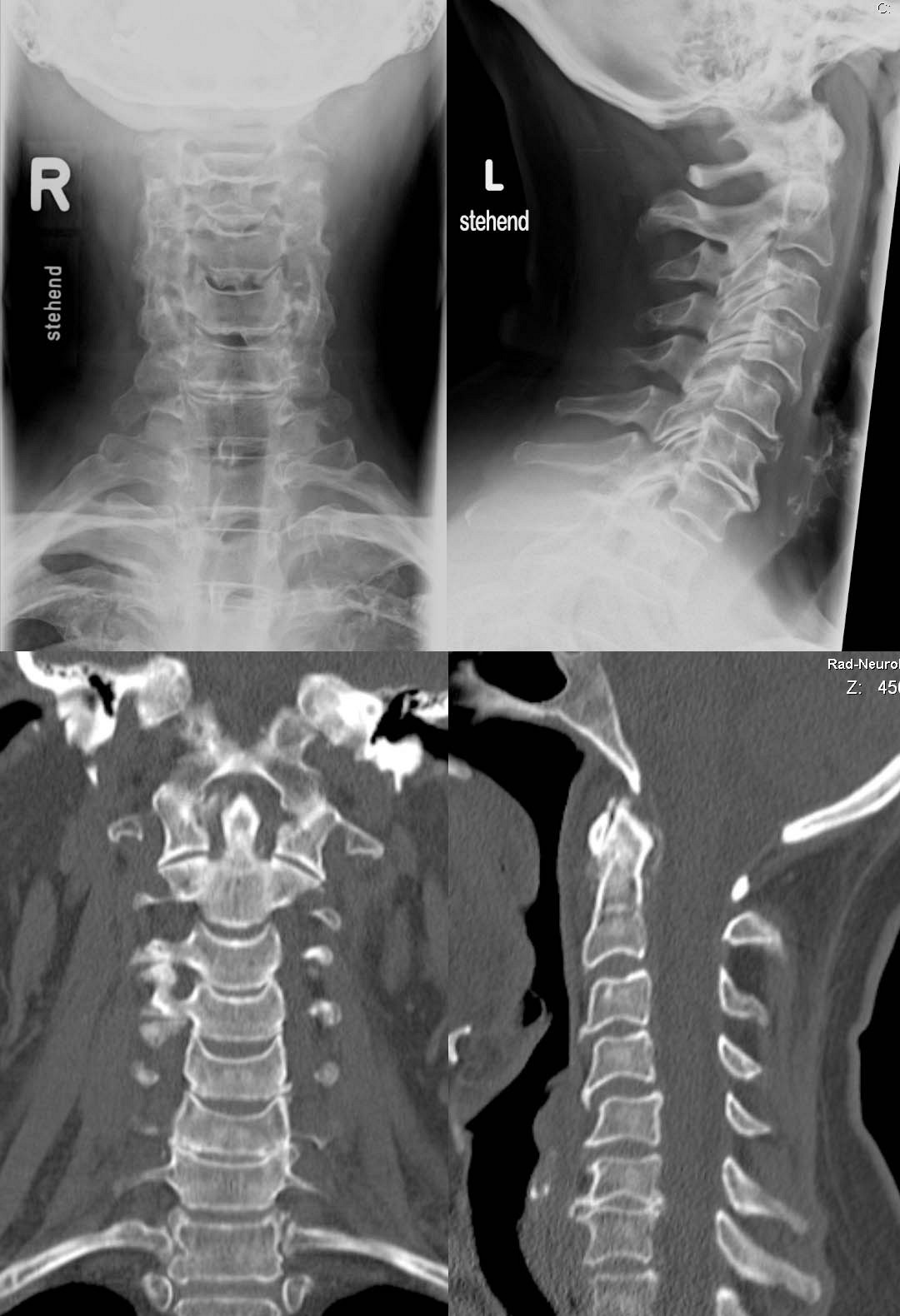 Bild 10/11 - Röntgen: Starke Nackenschmerzen, 76-j. Frau