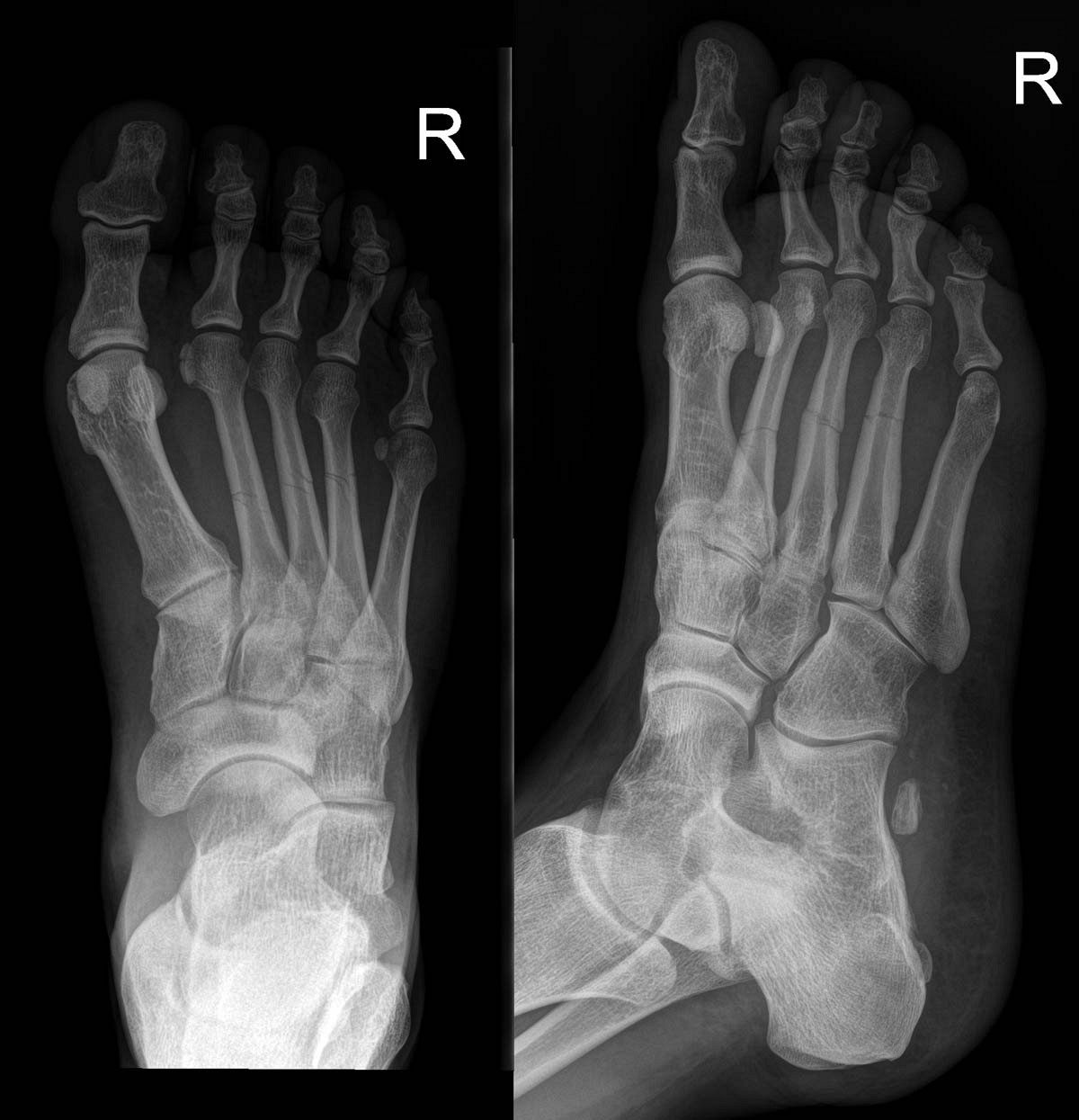 Bild 59/59 - Röntgen: Fussvereltzung, 44-j. Mann