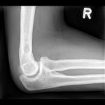 Rx: Ellbogen seitlich ru