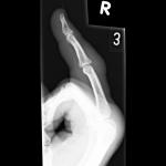 Rx: Finger seitlich ru