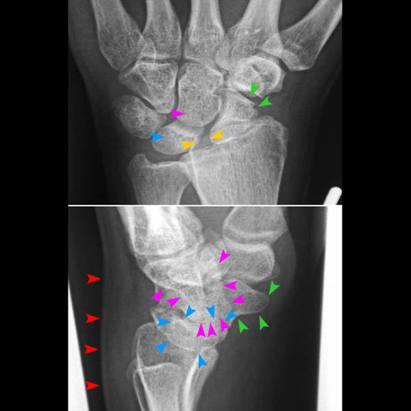 Schmerzen Im Handwurzelknochen