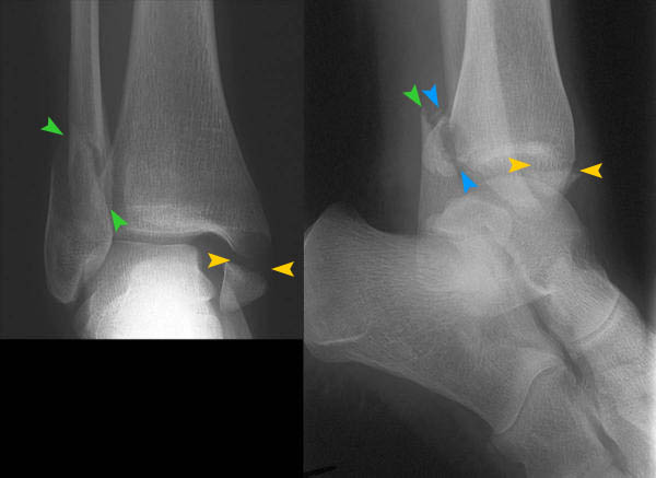 Bild 3/39 - Röntgen: Misstritt auf Treppe, 29-j. Frau