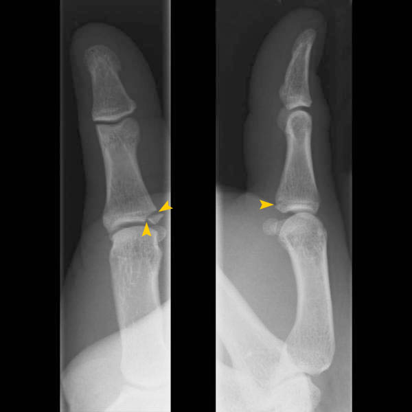 Radiologische Zeichen sind: