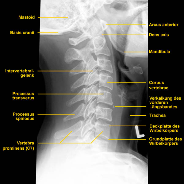 Bild 2/4 - Röntgen: HWS seitlich