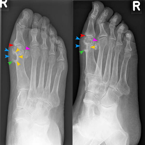 Fuss dp/schräg rechts d1