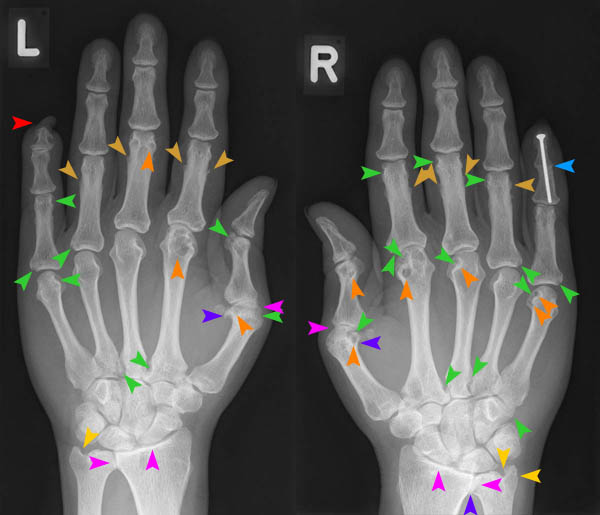 Radiologische Zeichen sind: