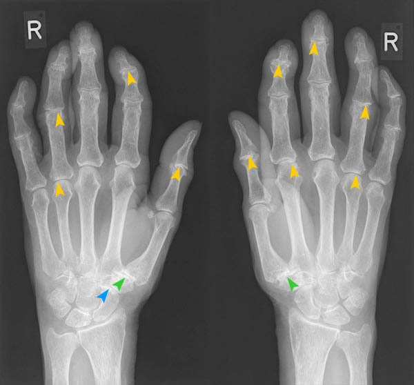 Radiologische Zeichen sind: