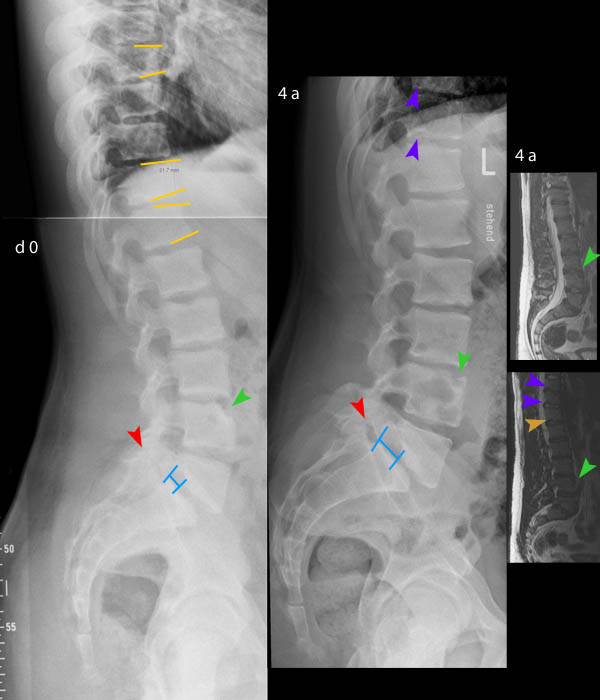 Bild 16/17 - Röntgen: Lumbalgie mit Ausstrahlung ins linke Bein, 12-j ...