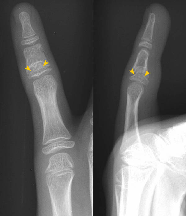 BWS ap/lat. BWS ap mit Pfeilen. MR BWS sag, axial Th 9, Th10.