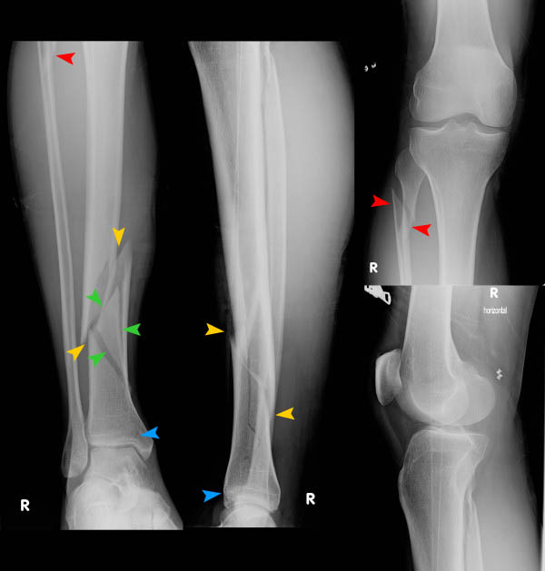 Ossa Rotte Radiografia Foto Radiografia Dell'artrite, Immagini E